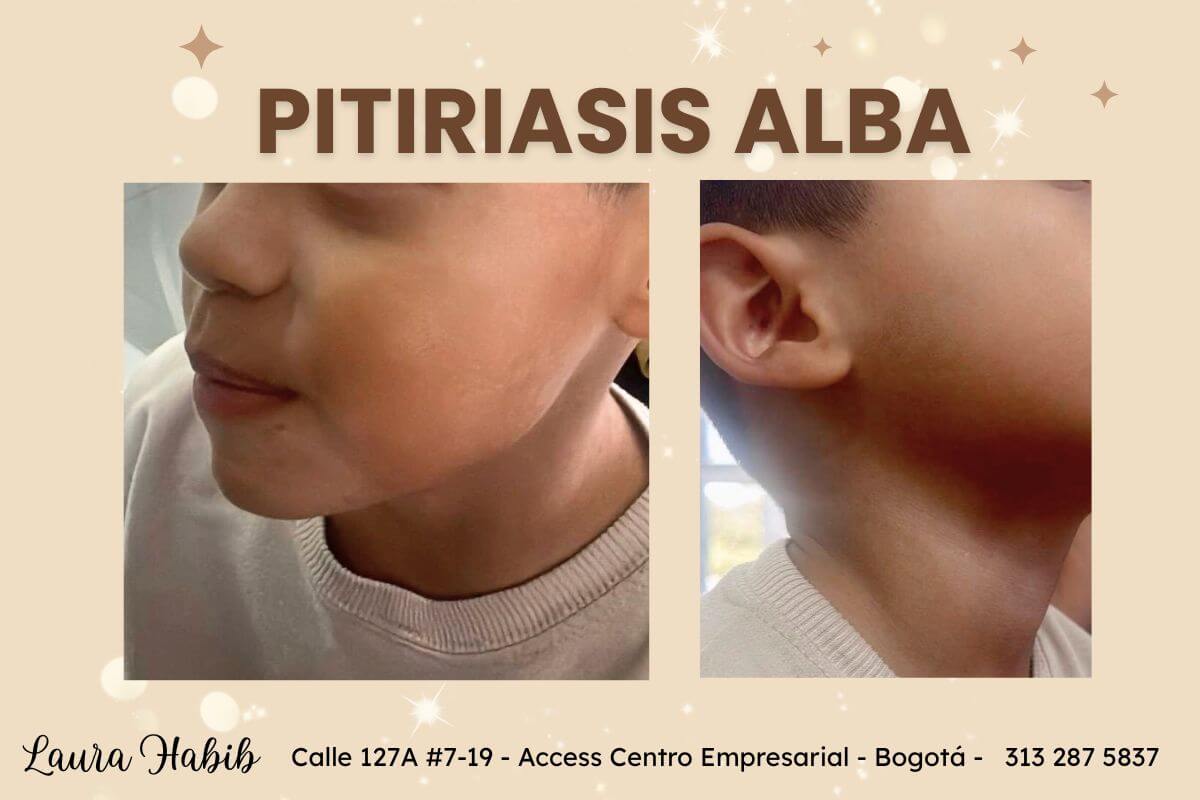 Understanding Pityriasis Alba by a Dermatologist in Bogotá